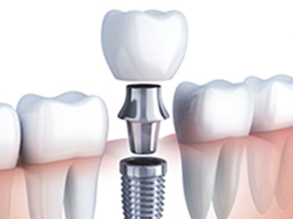 Implantes Fonasa - Naturasmile