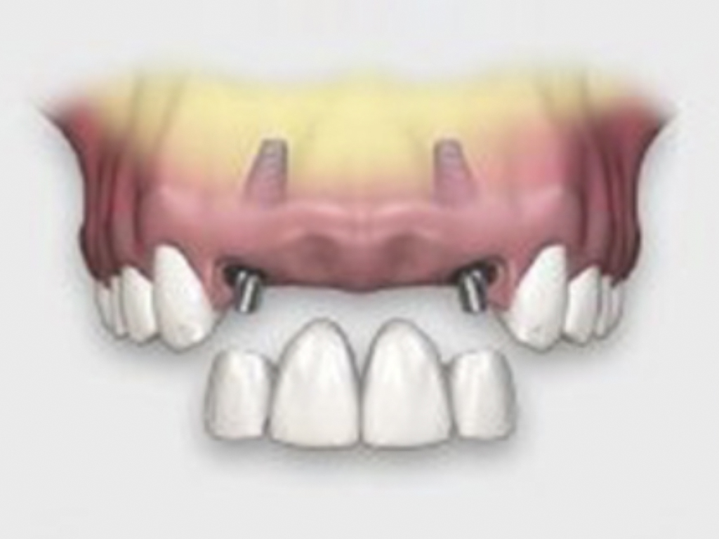 Implantes Fonasa - Naturasmile