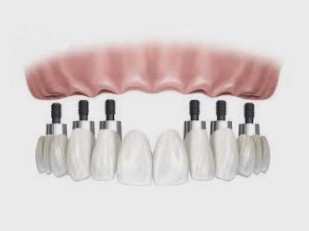 Implantes Fonasa - Naturasmile